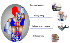 Back Pain ICD 10 Code Guidelines - Low back Examples